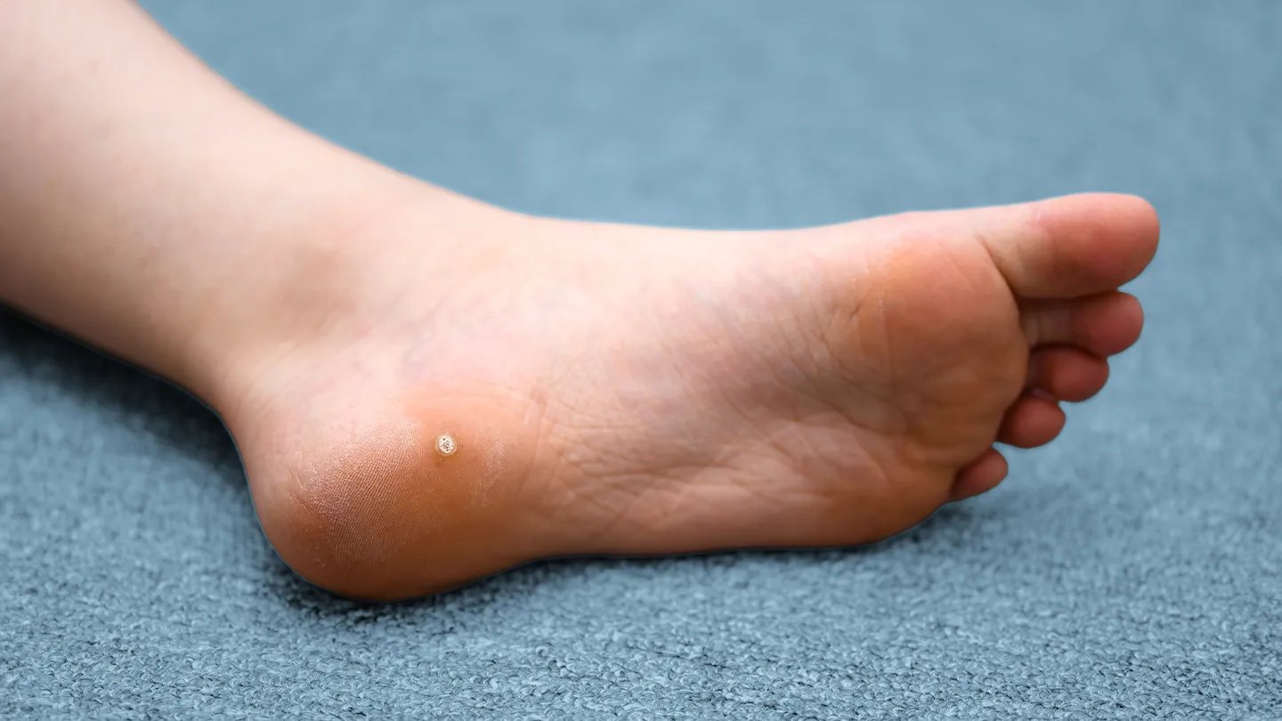 When Skin and Breath Are at Risk by Knowing Plantar Wart Symptoms and ...